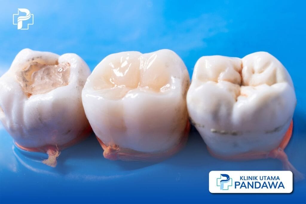 Ini 5 Jenis Bahan untuk Prosedur Tambal Gigi - Klinik Pandawa